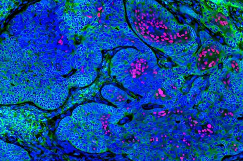 Basal cell carcinoma's low immunogenicity linked to suppression of ...