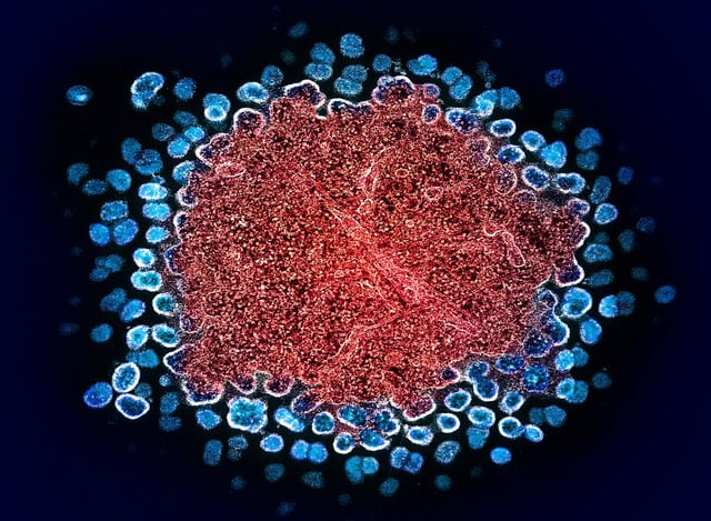 Person functionally cured of HIV after bone marrow transplant from ...
