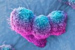 Pancreatic cancer halted by virus injection in three patients. A cancer ...