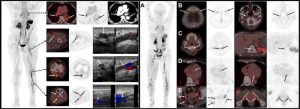New PET tracer identifies DVT in legs and lungs - Australian Online News